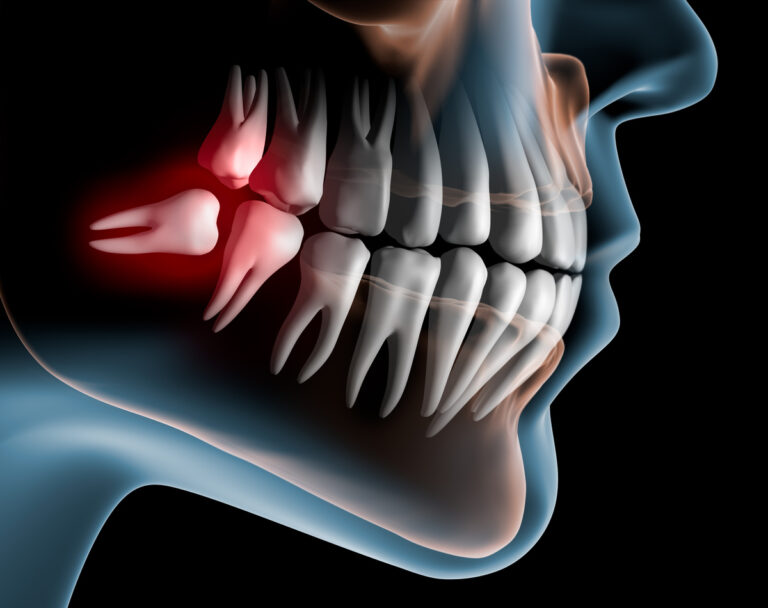 Local vs. General Anesthetic Options for Wisdom Teeth Removal – Warren ...